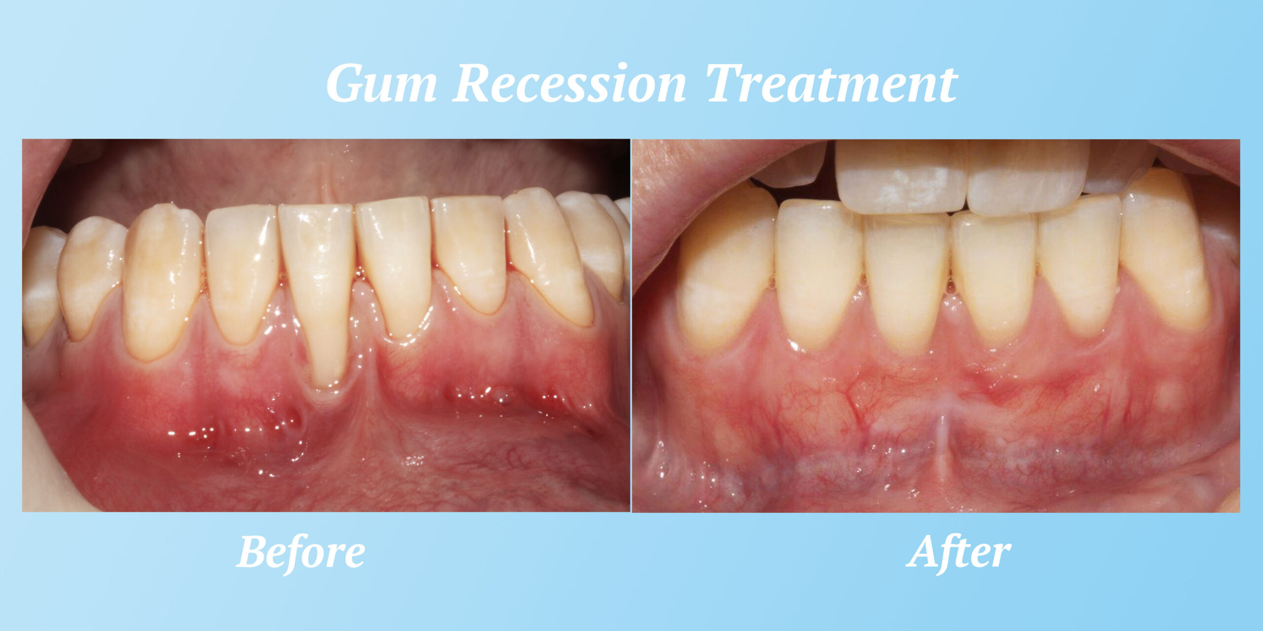 Laser Dentistry Maroubra | Laser Dental Maroubra